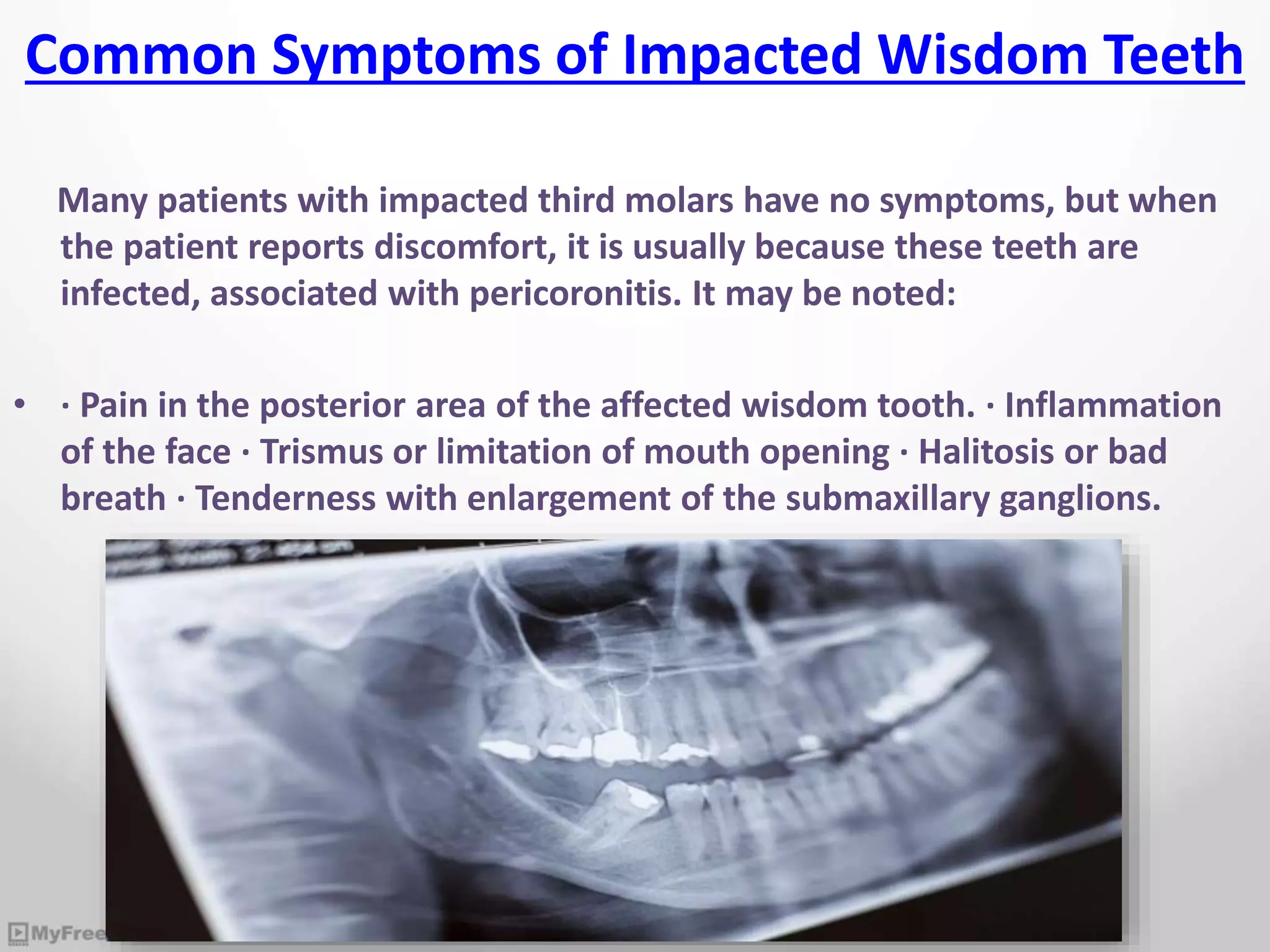 Wisdom teeth | PDF