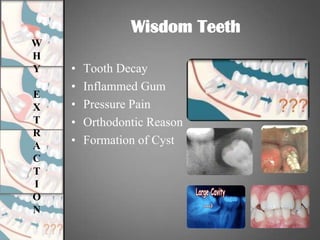 Wisdom teeth | PPTX