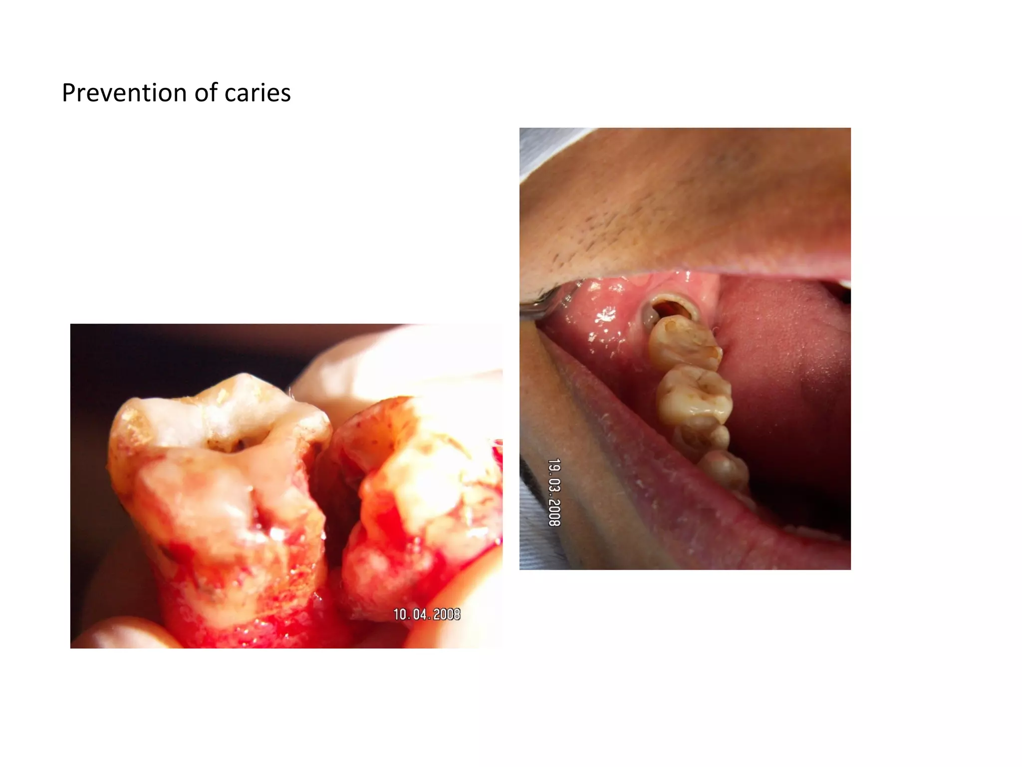 Wisdom Tooth Impaction | PPT