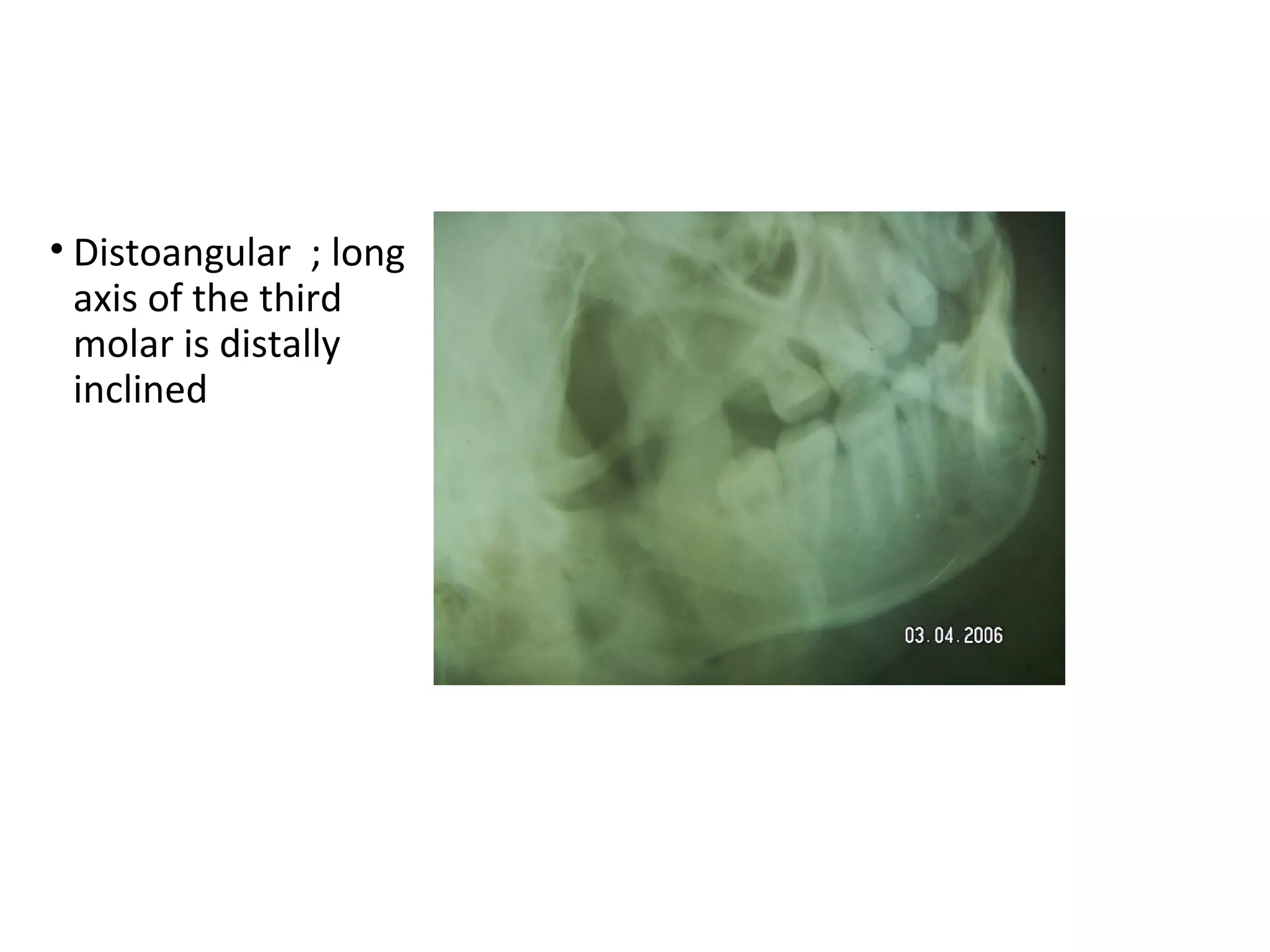 Wisdom Tooth Impaction | PPT