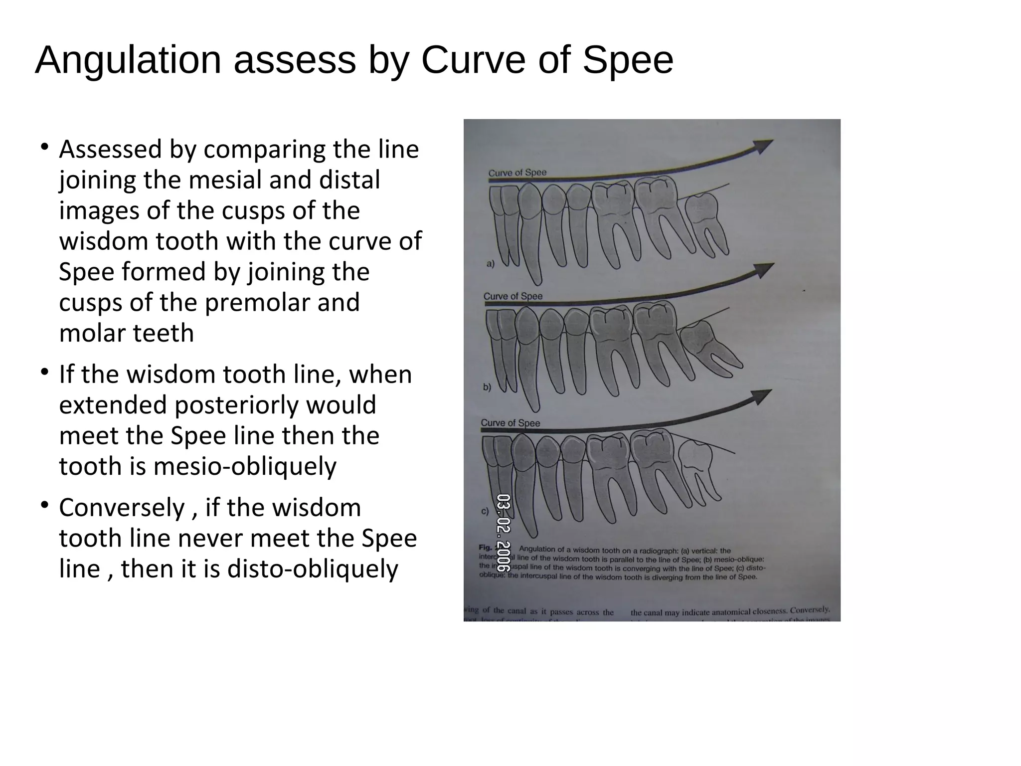 Wisdom Tooth Impaction | PPT