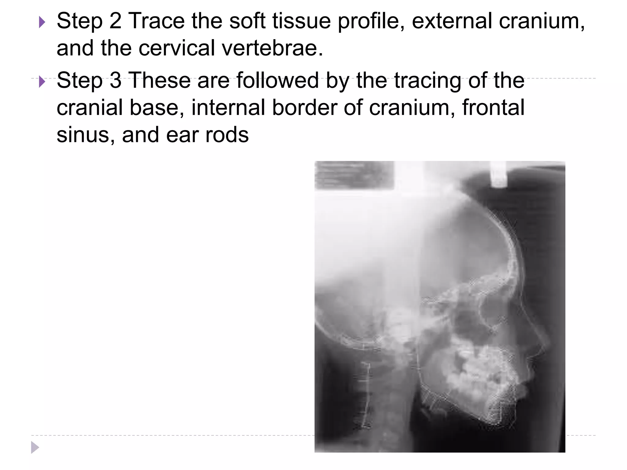 cephalometric in orthodontics and Wits appraisal | PPTX