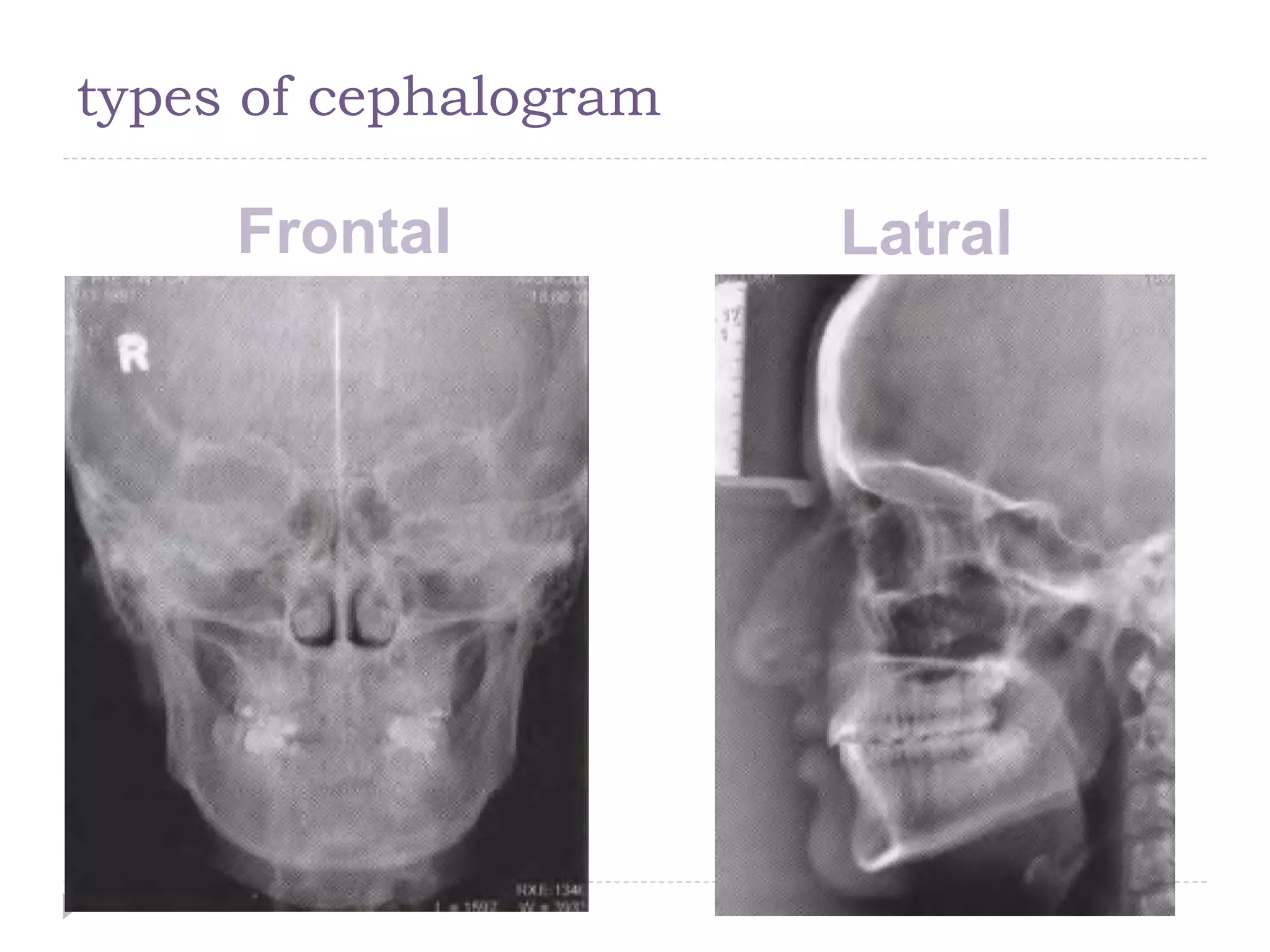 cephalometric in orthodontics and Wits appraisal | PPTX