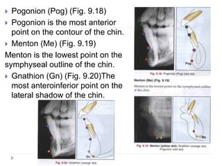 cephalometric in orthodontics and Wits appraisal | PPTX