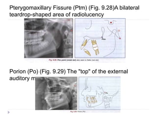 cephalometric in orthodontics and Wits appraisal | PPTX
