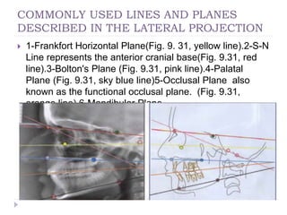 cephalometric in orthodontics and Wits appraisal | PPTX