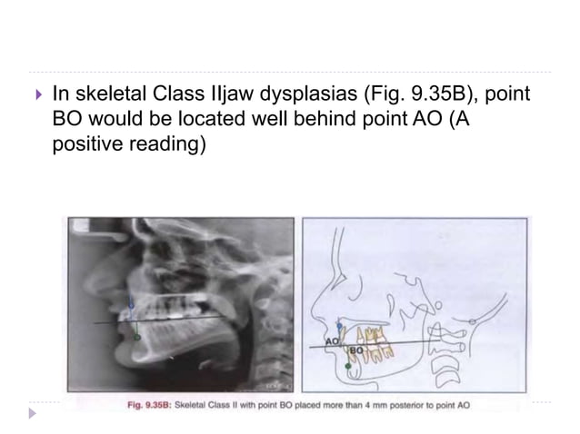 cephalometric in orthodontics and Wits appraisal | PPTX | Dental Health ...