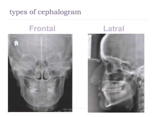 cephalometric in orthodontics and Wits appraisal | PPTX