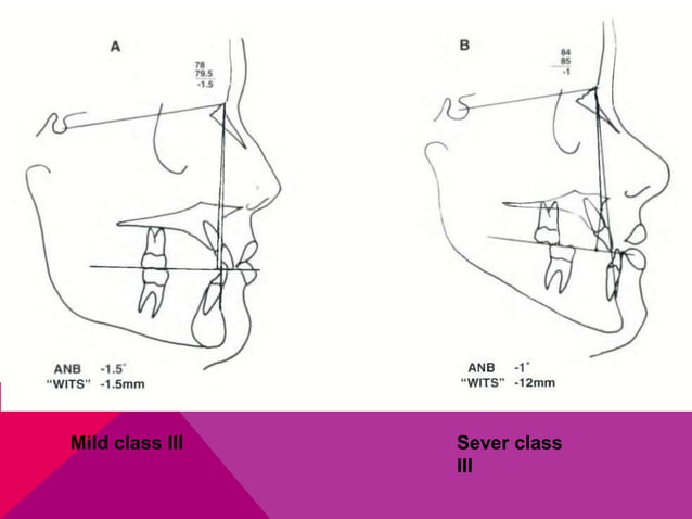Wits appraisal | PPTX | Dental Health | Diseases and Conditions