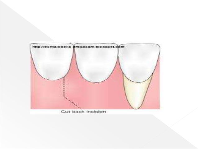 Principles of flap surgery copy