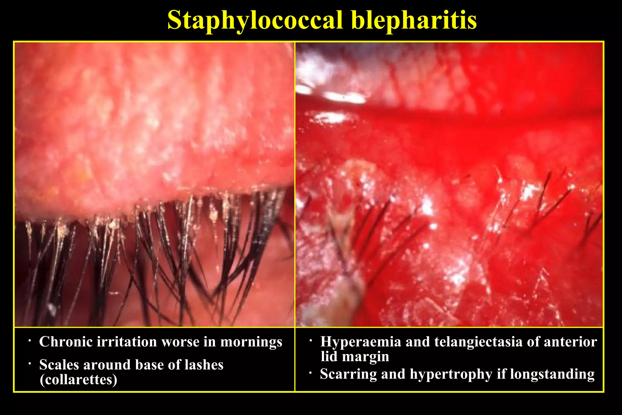 02 chronic marg bleph'tis | PPT