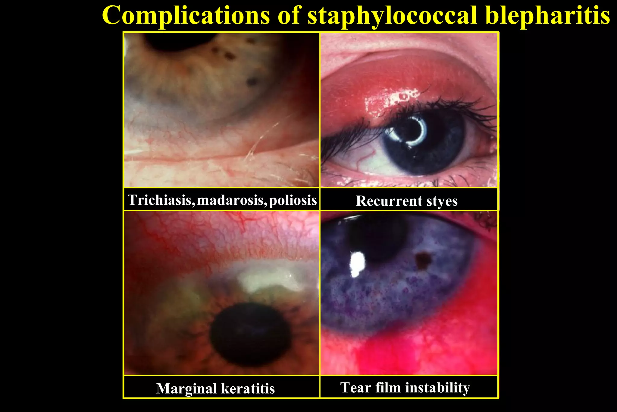 02 chronic marg bleph'tis | PPT
