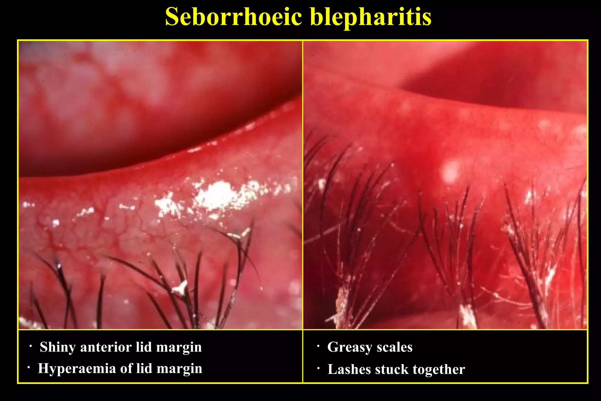 02 chronic marg bleph'tis | PPT