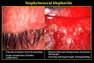 02 chronic marg bleph'tis | PPT