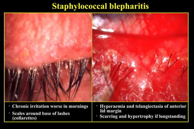02 chronic marg bleph'tis | PPT