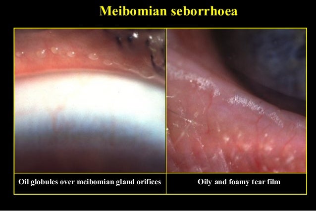 02 chronic marg bleph'tis