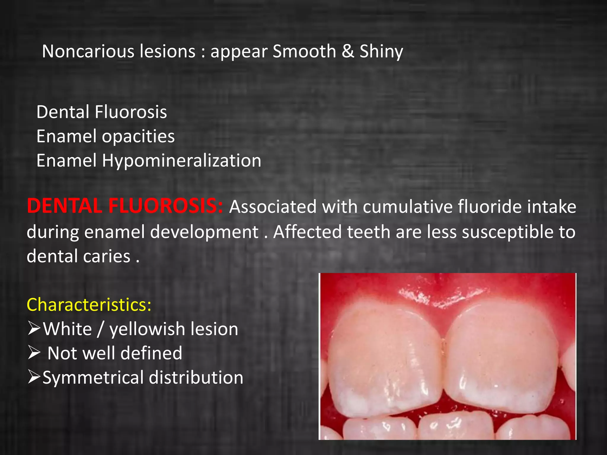 White spot lesions | PPTX
