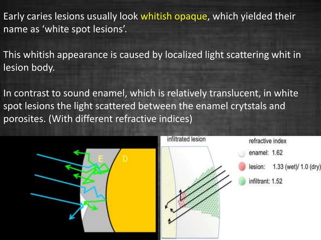 White spot lesions | PPTX