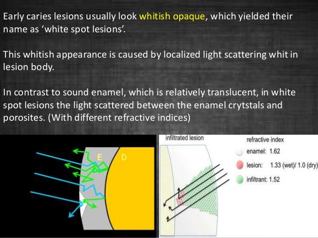 White spot lesions