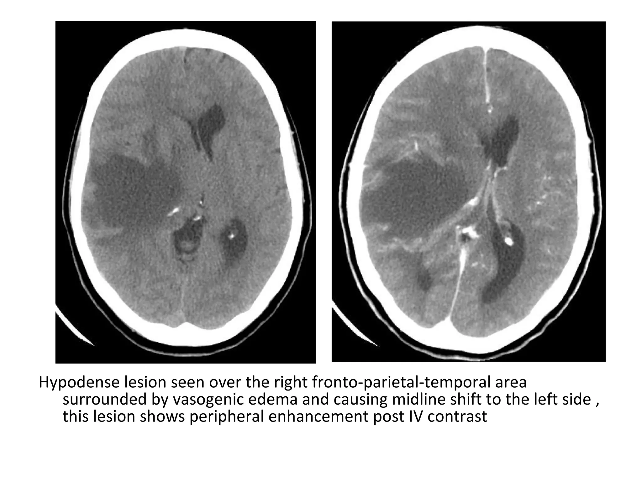 Diagnostic Imaging of Degenerative & White Matter Diseases | PPT