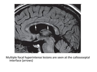 Diagnostic Imaging of Degenerative & White Matter Diseases | PPT