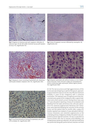 Angiosarcoma in the large intestine - evaluation and management | PDF