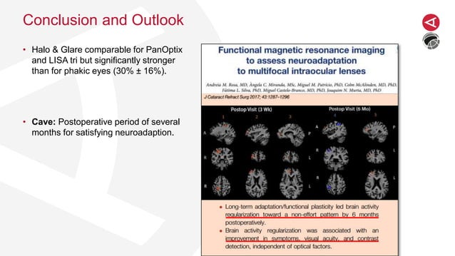 Introduction of a new diffractive trifocal intraocular lens. Comparison ...