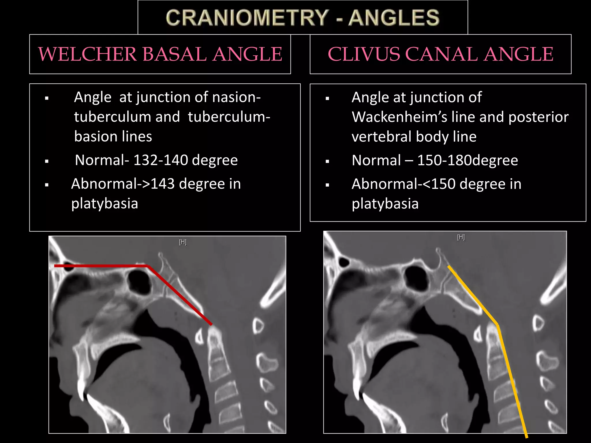 Craniovertebral anomalies | PPTX
