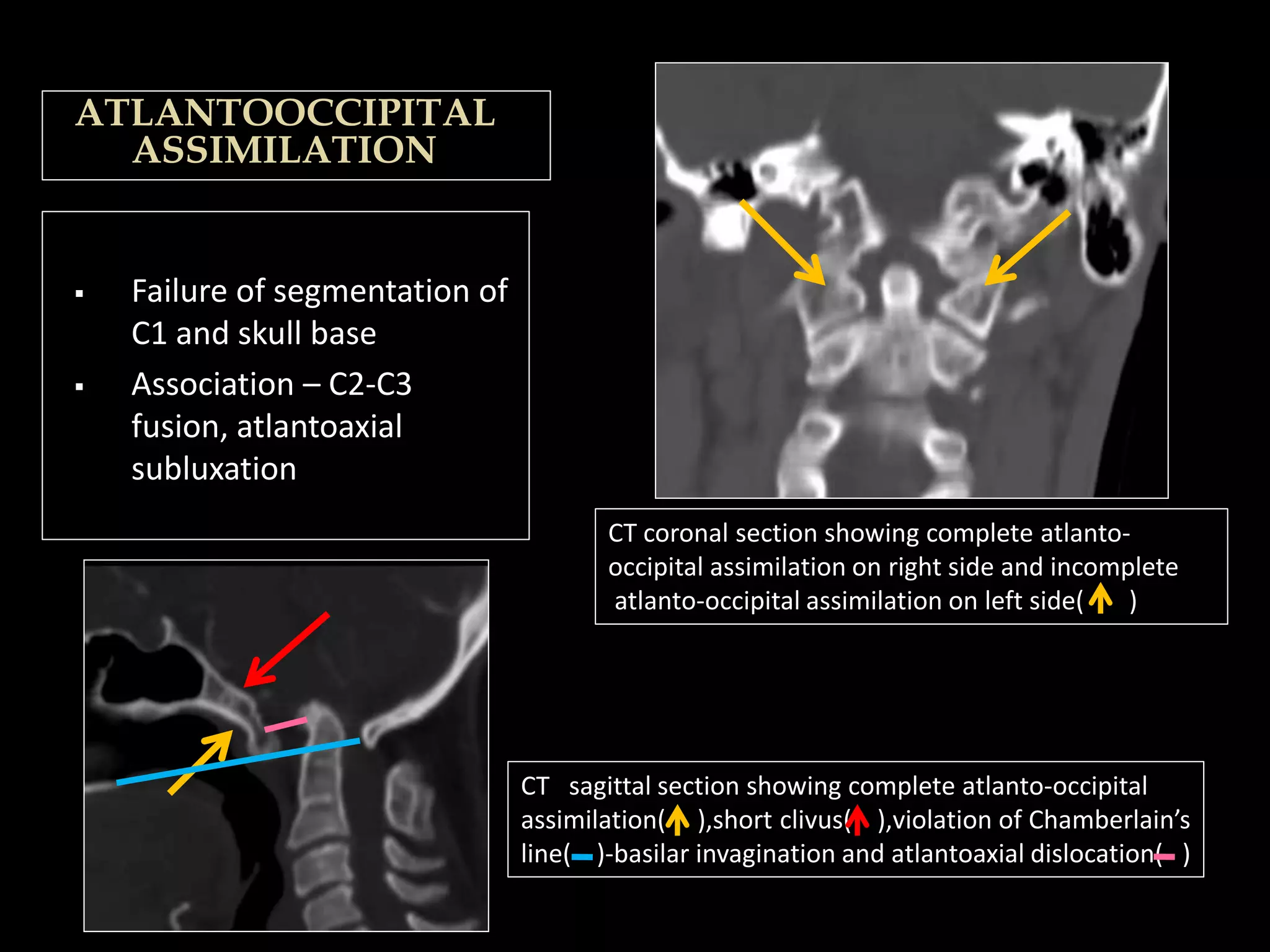 Craniovertebral anomalies | PPTX
