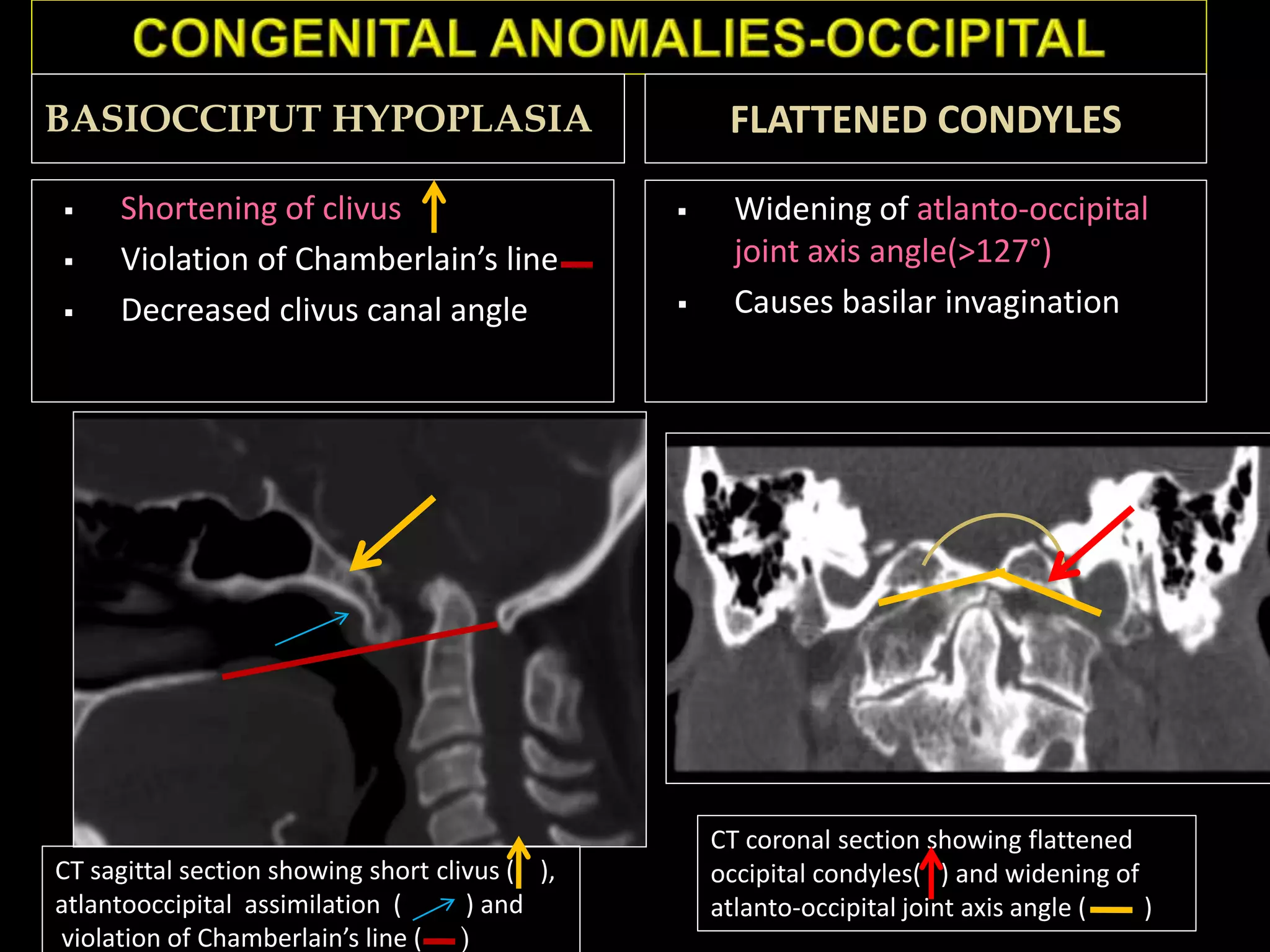Craniovertebral anomalies | PPTX