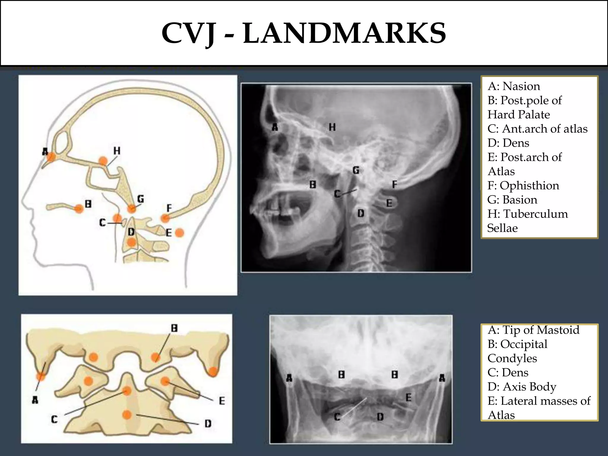 Craniovertebral anomalies | PPTX