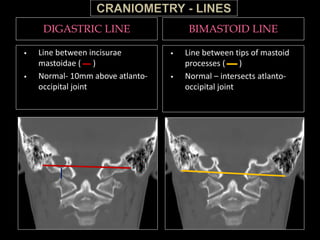 Craniovertebral anomalies | PPTX