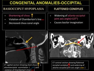 Craniovertebral anomalies | PPTX