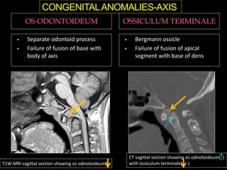 Craniovertebral anomalies | PPTX