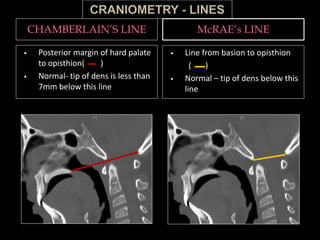 Craniovertebral anomalies | PPTX