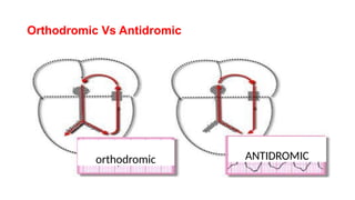 lecture on Wolff-Parkinson-White (WPW) Syndrome | PPTX