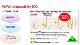 lecture on Wolff-Parkinson-White (WPW) Syndrome | PPTX