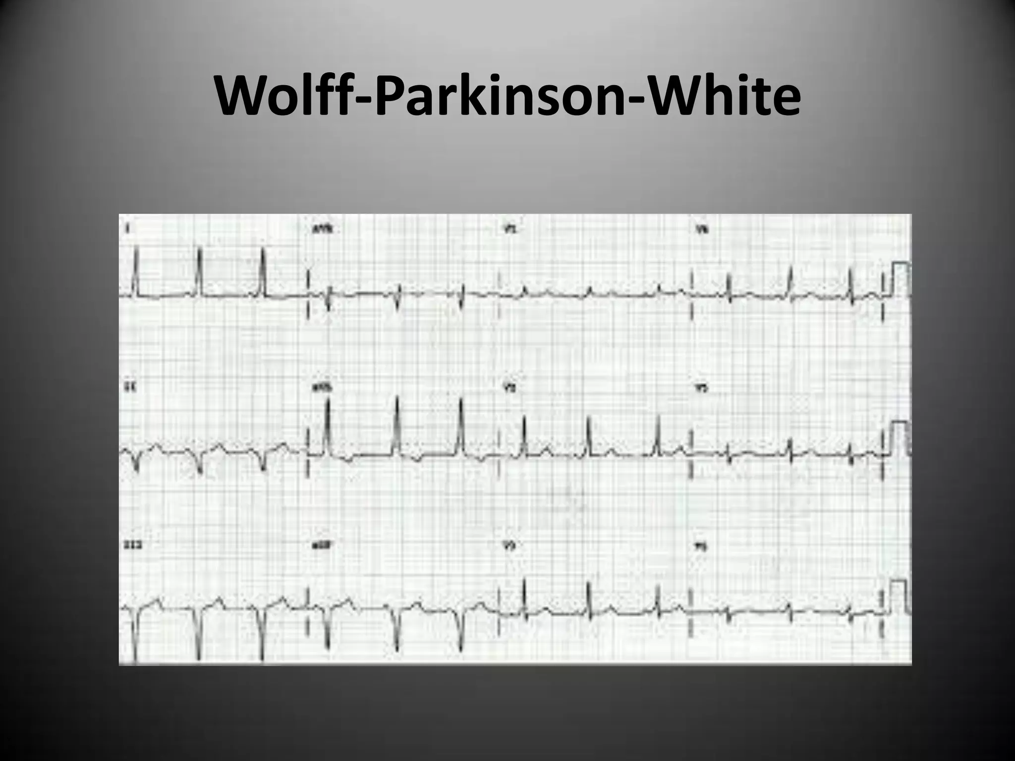 Wolff parkinson white | PPT