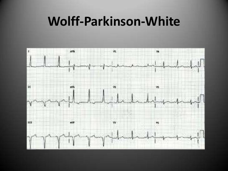 Wolff parkinson white