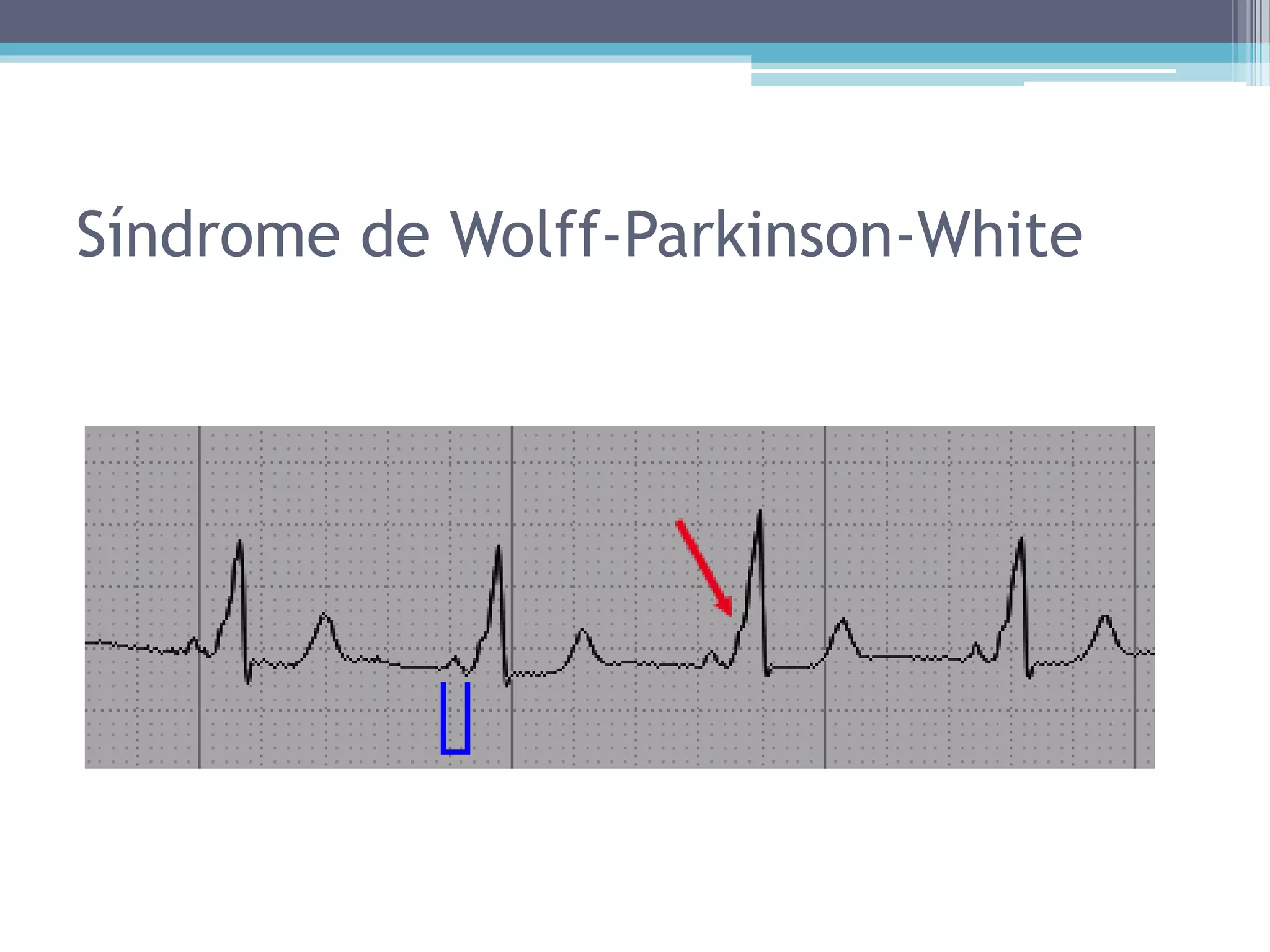 Wolf parkinson white | PPT
