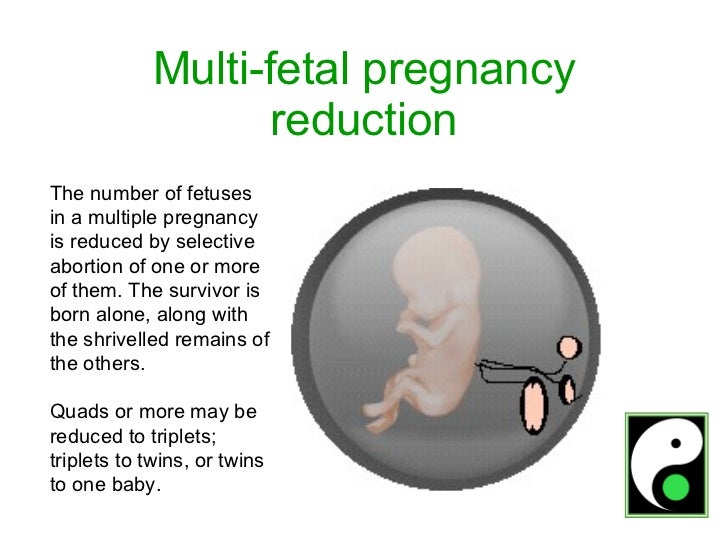 Womb Twin Survivors (1) - Signs of a twin