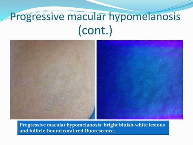 Wood’s light in dermatology | PPTX | Skin and Dermatology | Diseases ...
