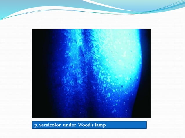 Wood’s light in dermatology