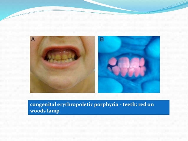 Wood’s light in dermatology