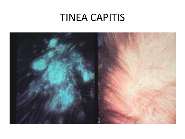 Wood's lamp by aseem