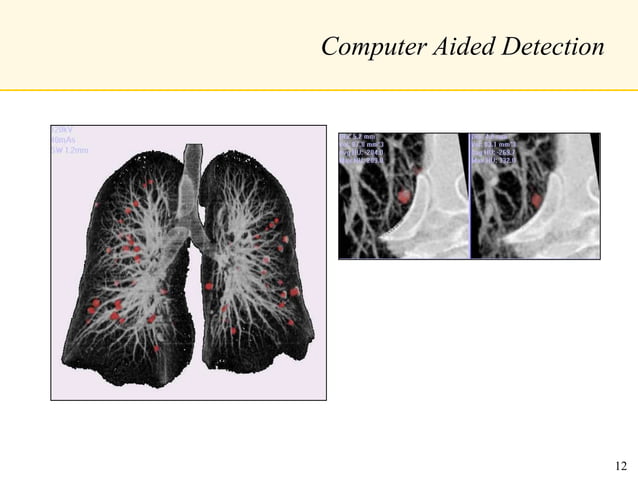 Image processing in lung cancer screening and treatment | PPTX