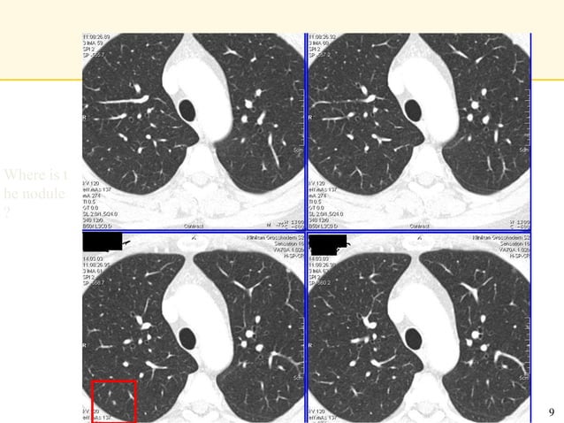 Image processing in lung cancer screening and treatment | PPTX