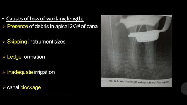 Working length Determination | PPTX
