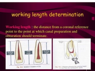 working length | PPT