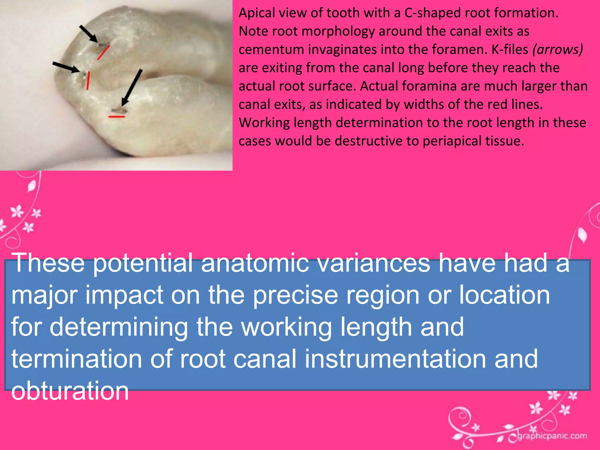 Working length determination | PPT